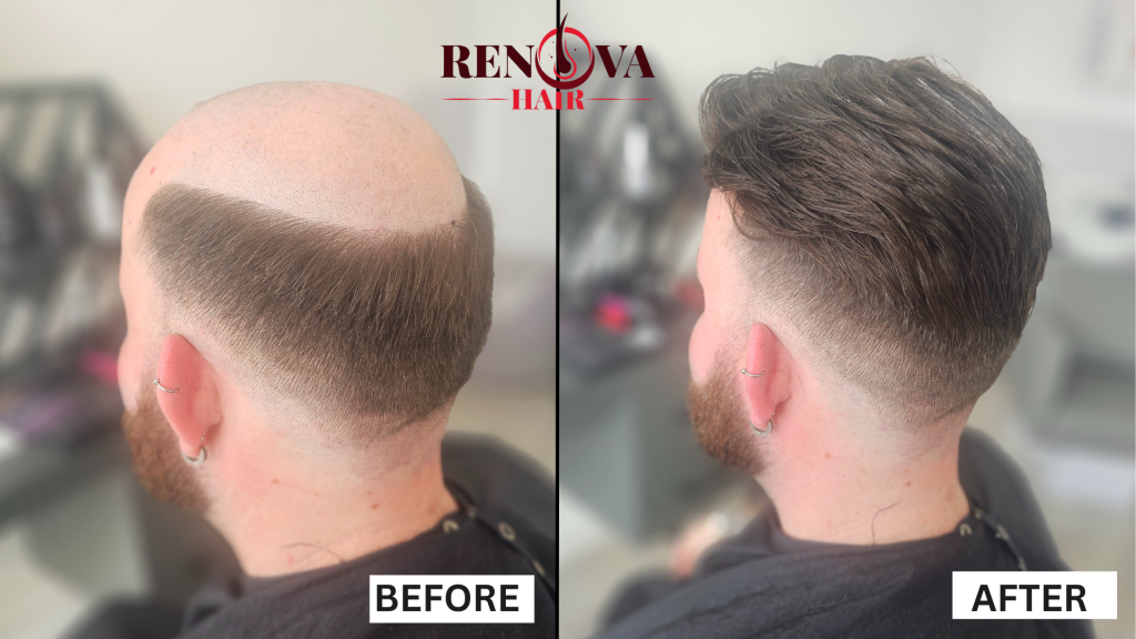 Hair System Before and After Results | Renova Hair